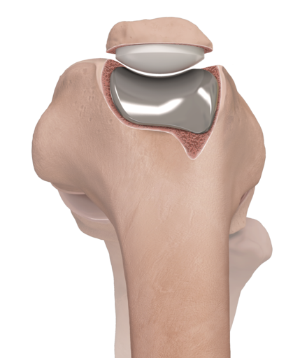 Arthrex - Patellofemoral Joint Arthroplasty (PFJ)