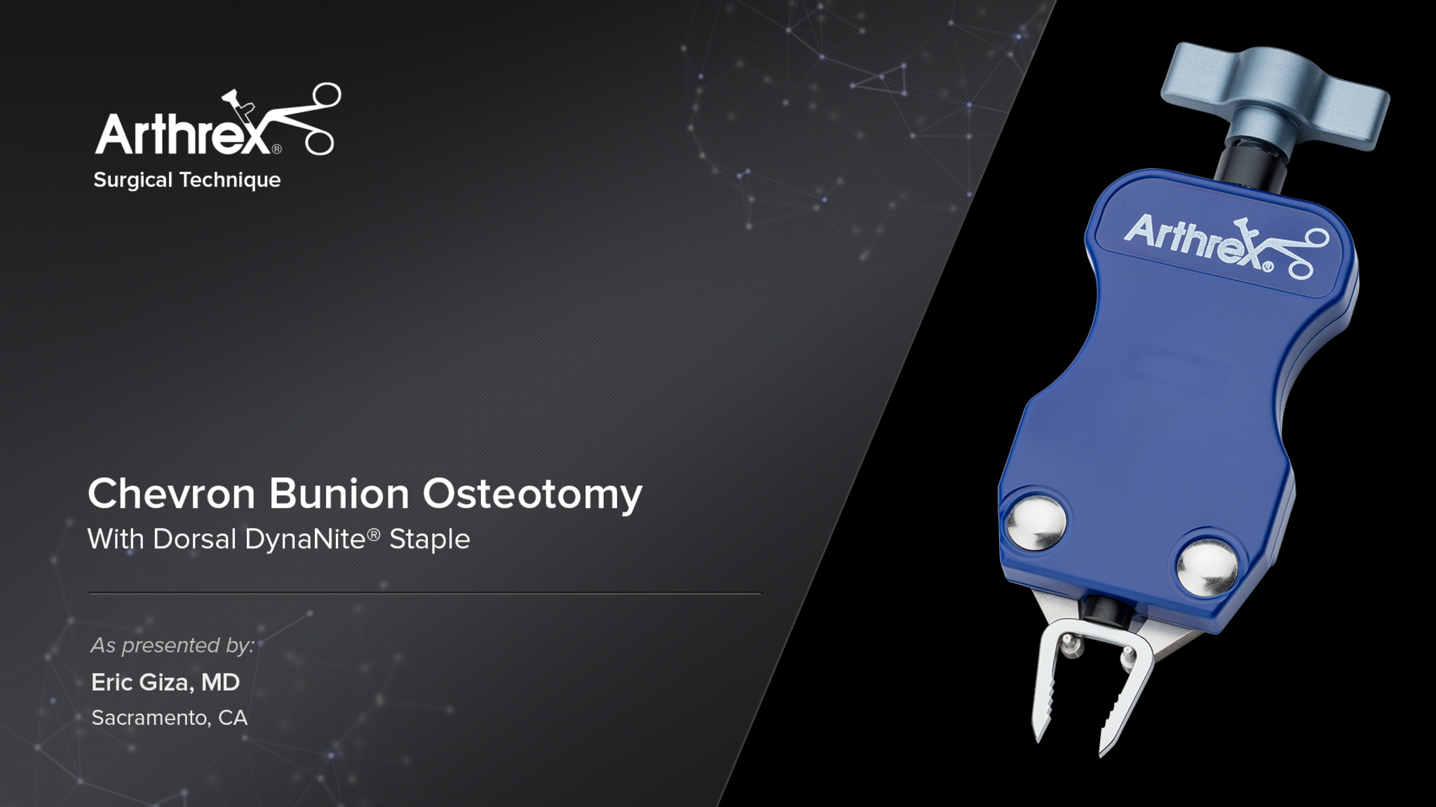 Arthrex - Chevron Bunion Osteotomy With Dorsal DynaNite® Staple