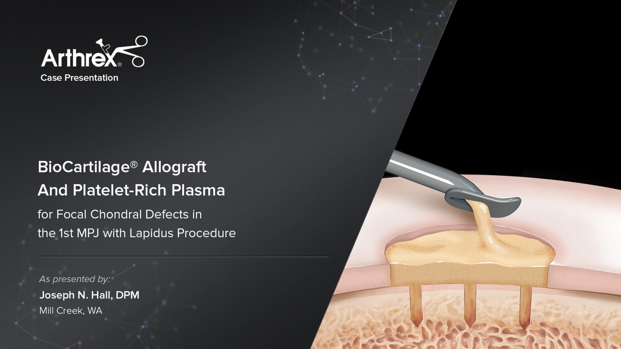 Arthrex - BioCartilage® Allograft and PRP for Focal Chondral Defects in ...