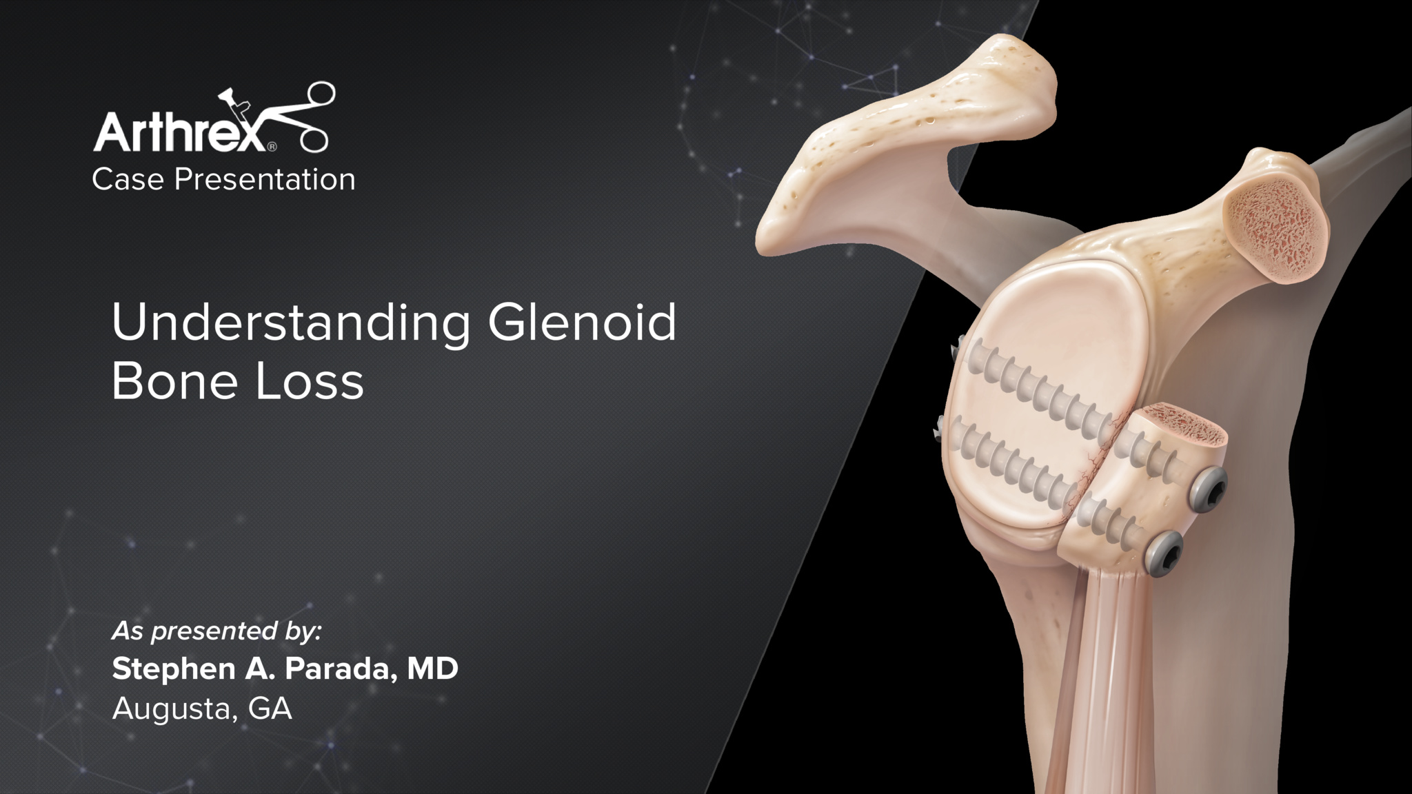 Arthrex - Understanding Glenoid Bone Loss