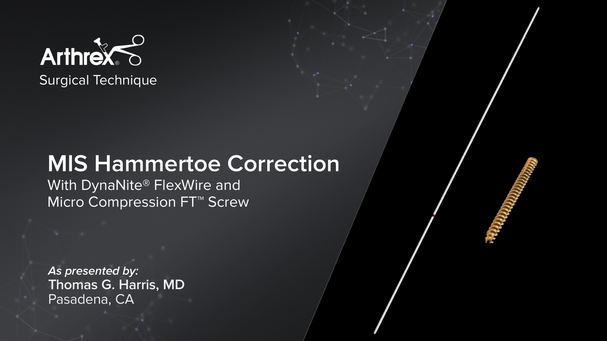 Arthrex - MIS Hammertoe Correction With DynaNite® FlexWire and Micro ...