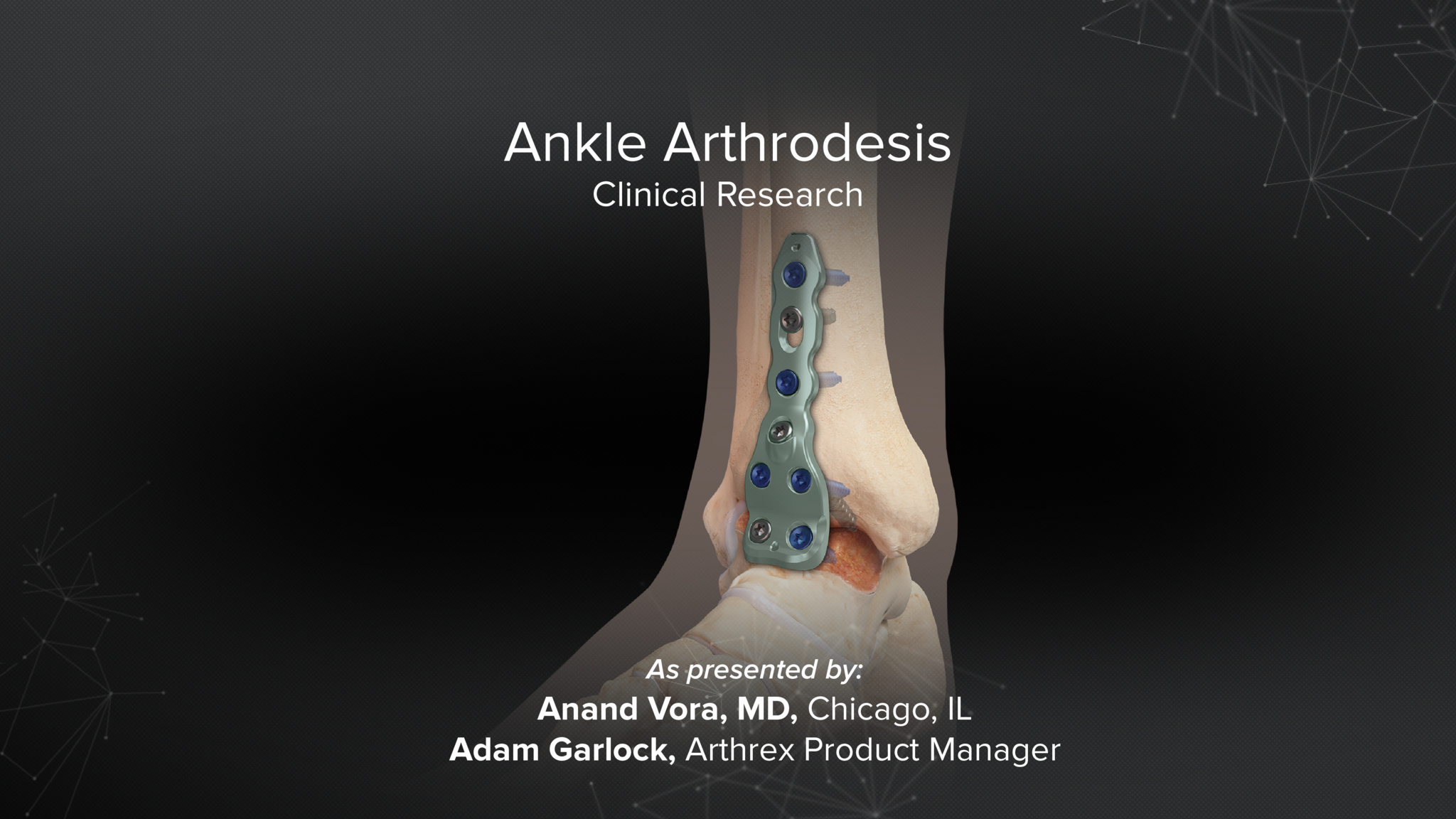 Arthrex - Ankle Arthrodesis: Clinical Research
