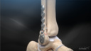 Arthrex - Syndesmosis TightRope® XP Implant System