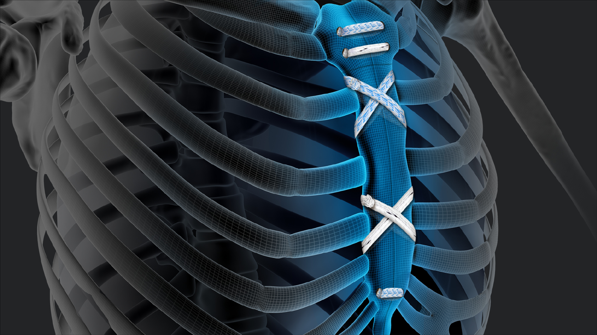 Arthrex - Dr. DiGiorgi FiberTape® Sternal Closure Surgeon Testimonial ...