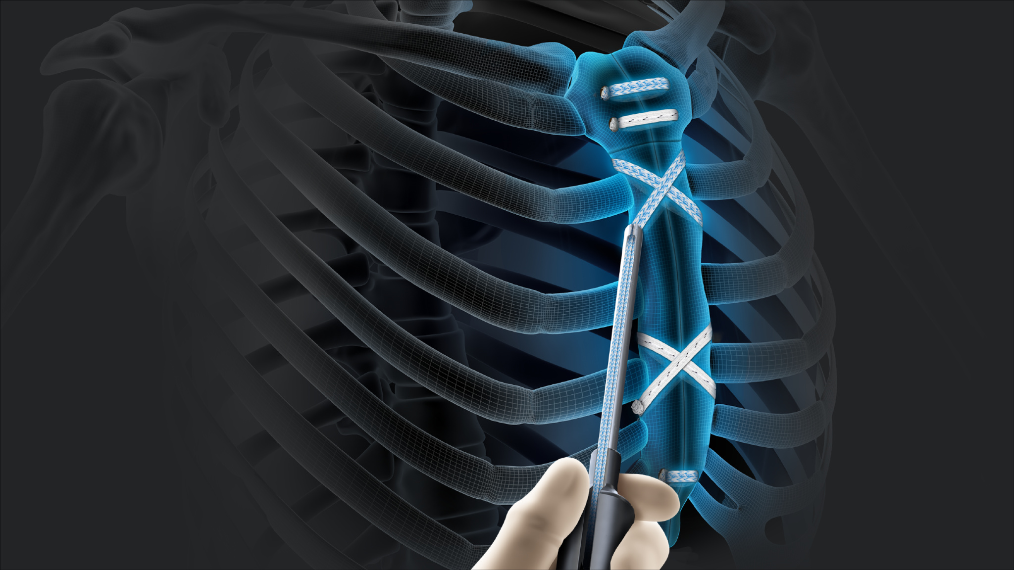 Arthrex - Dr. DiGiorgi FiberTape® Sternal Closure Surgeon Testimonial ...