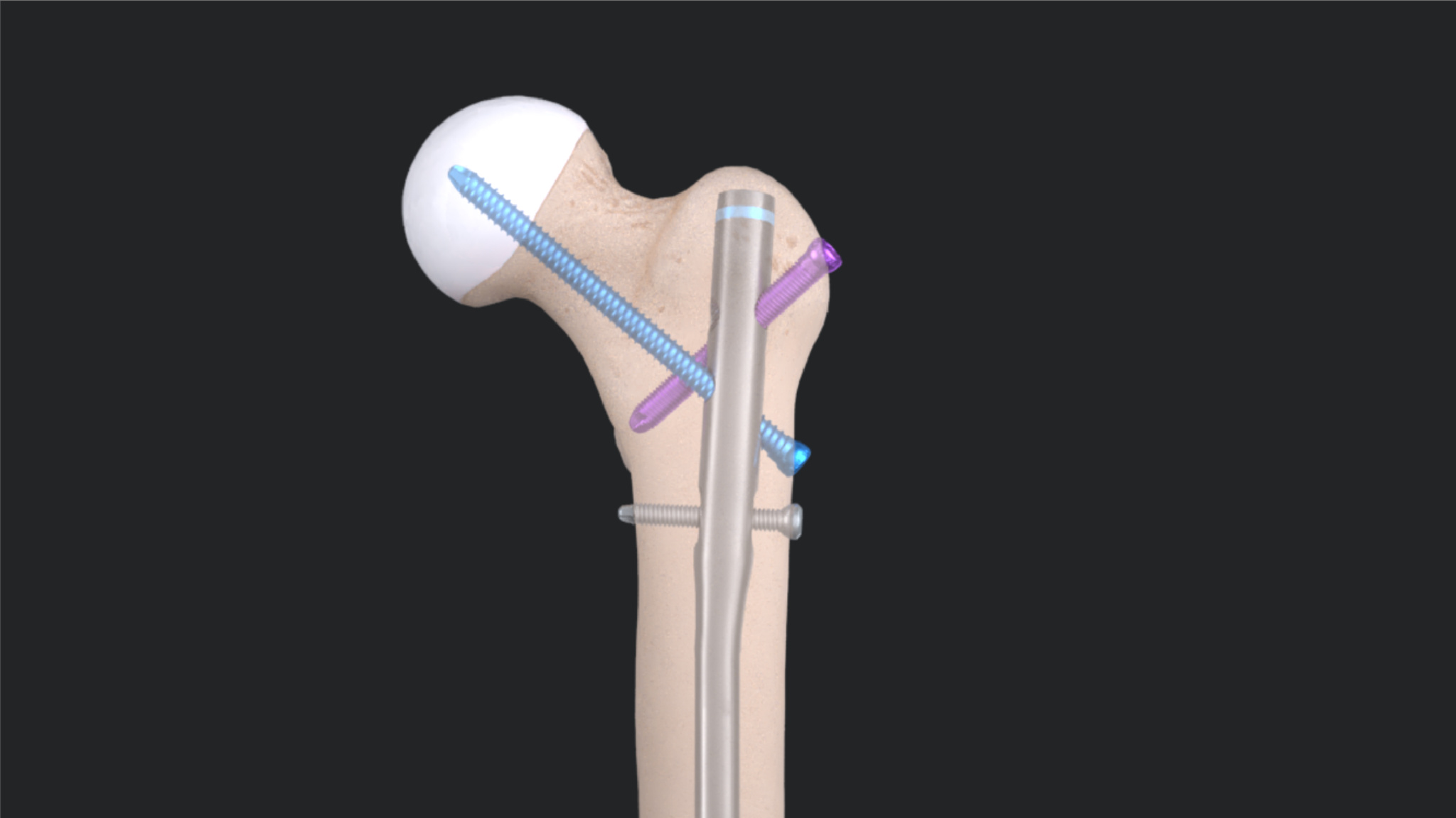 Arthrex - Antegrade Femoral Nail System Surgical Technique