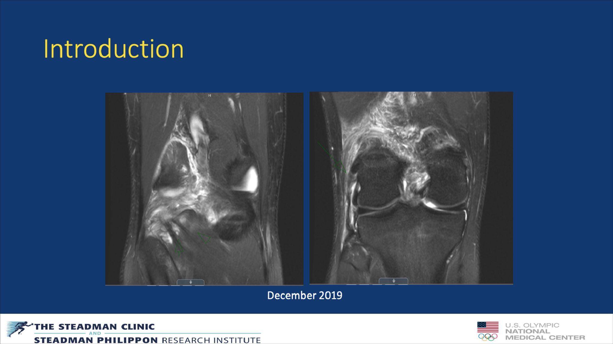 Arthrex - Fibular-Based Technique for Posterolateral Corner Reconstructions