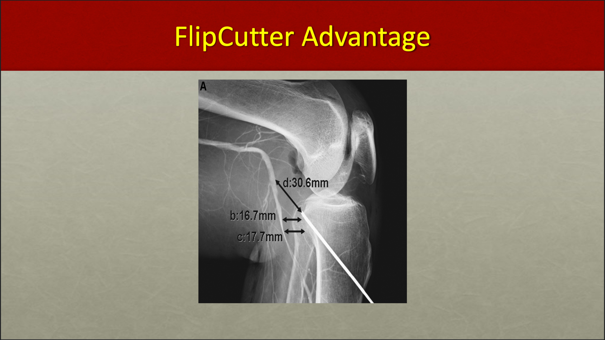 Arthrex - PCLR: There Is a Better Way