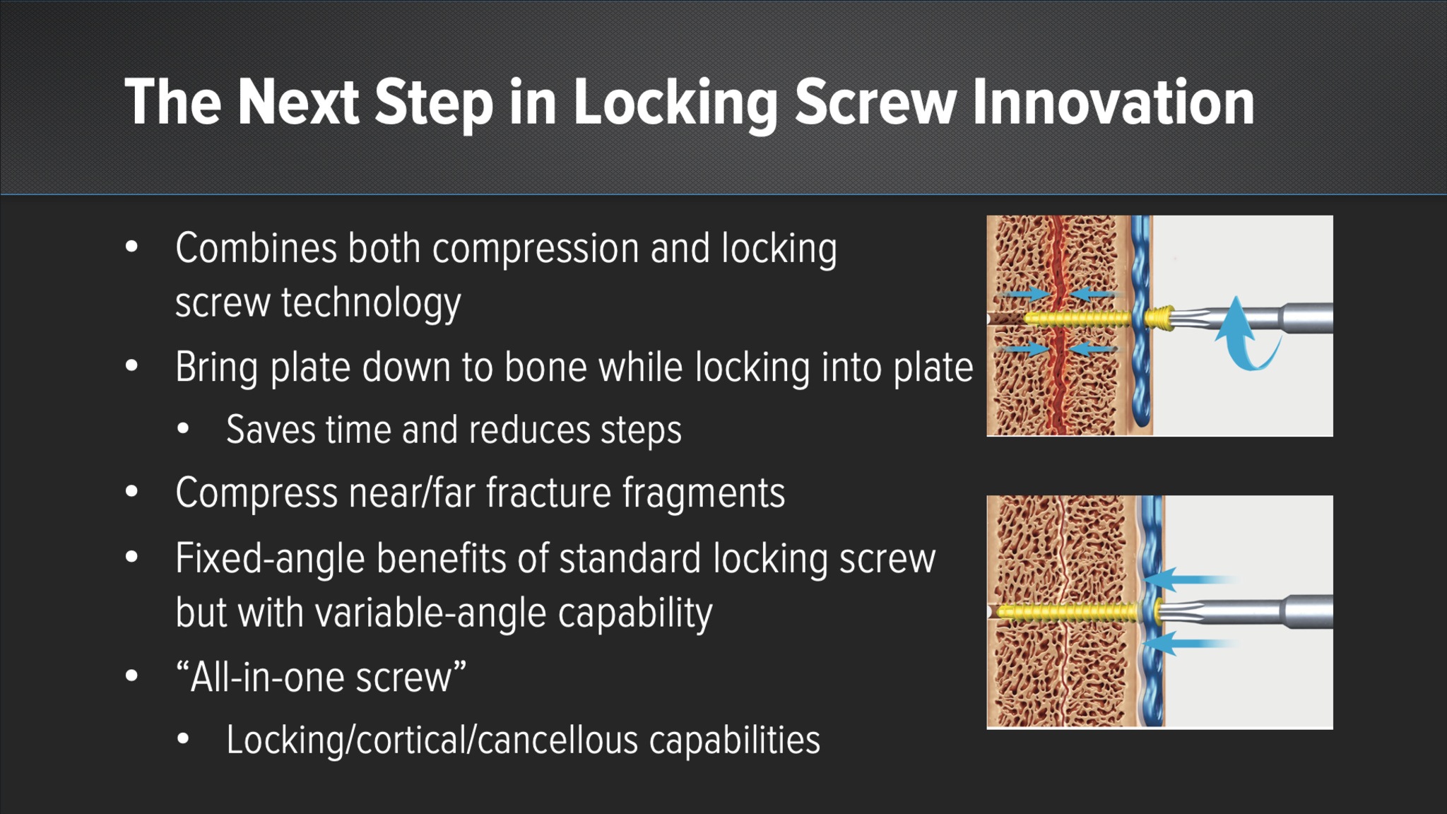 Arthrex - Calcaneus Fractures Using KreuLock™ Locking Compression Screws