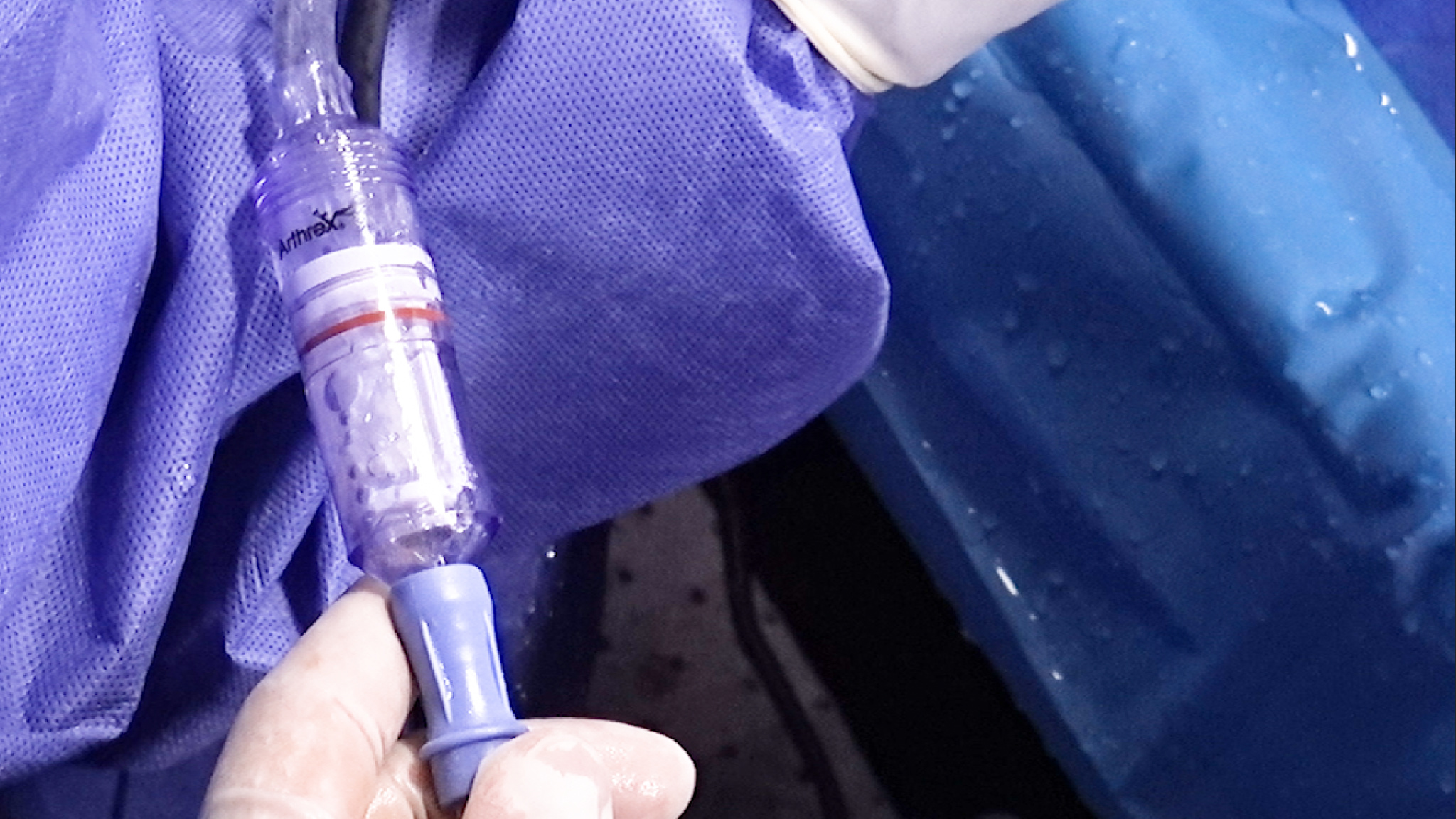 Arthrex - AutoCart™ Procedure for an Osteochondral Defect of the Trochlea