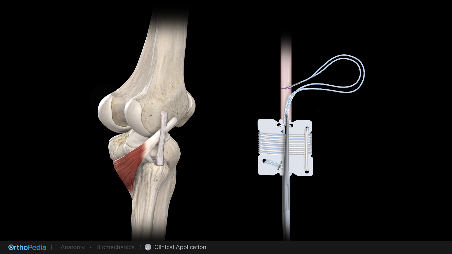 Knee Collateral Ligament Injury: Posterolateral Corner (PLC ...