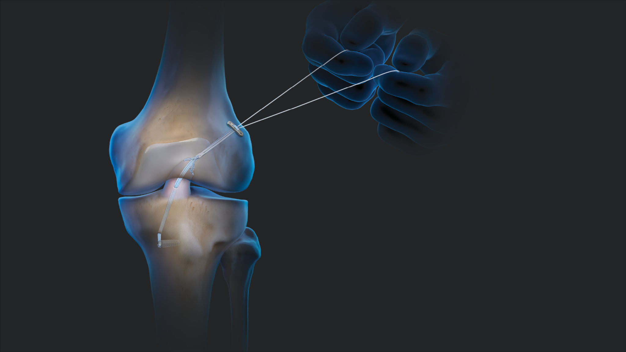 Arthrex - ACL Primary Repair Using the ACL Repair TightRope® Implant ...