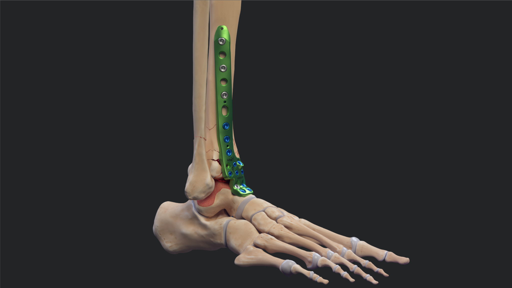 Arthrex - Surgical Technique for Primary Pilon Arthrodesis Using the ...