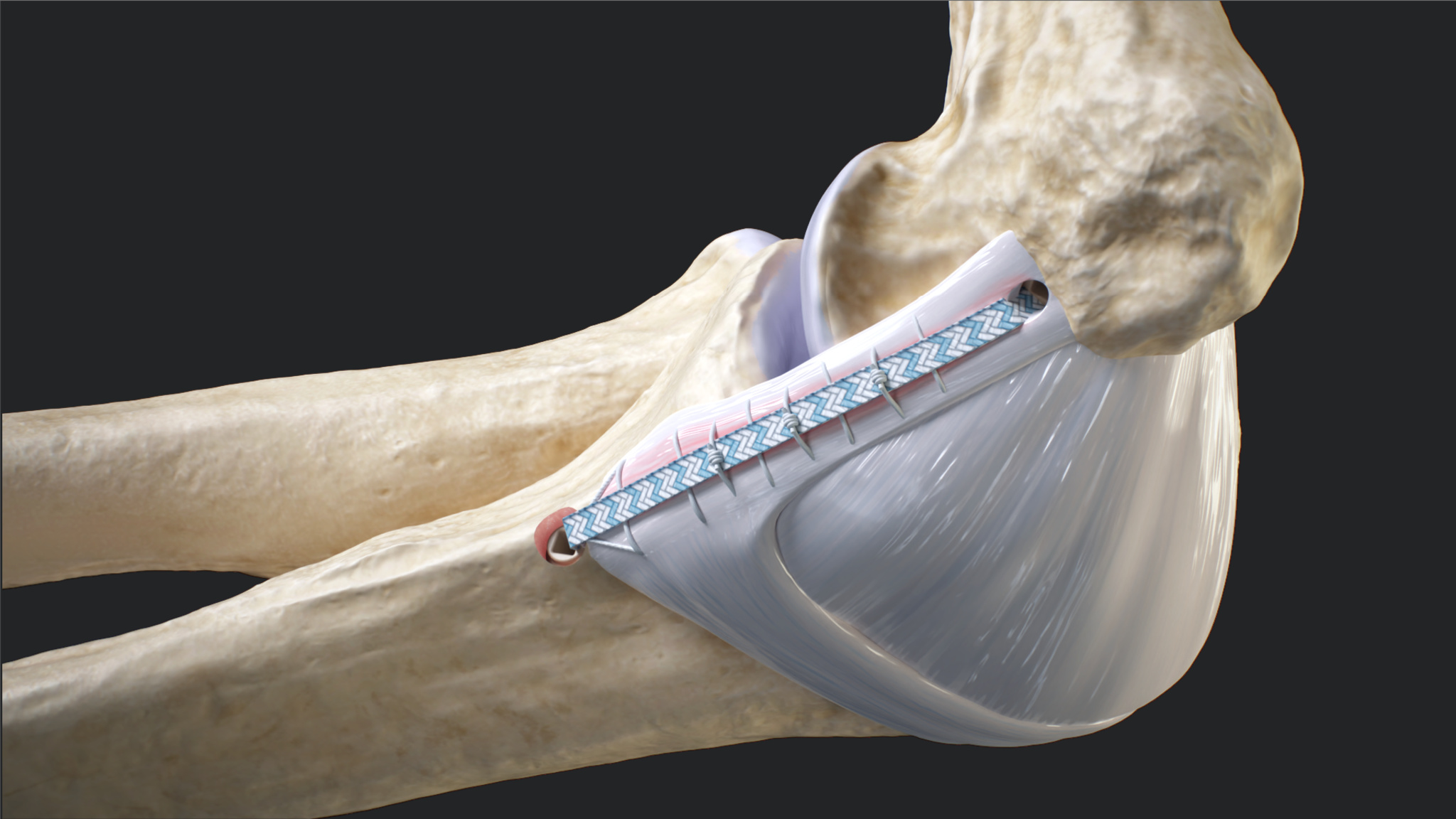 Arthrex - UCL InternalBrace™ System for MUCL Repair