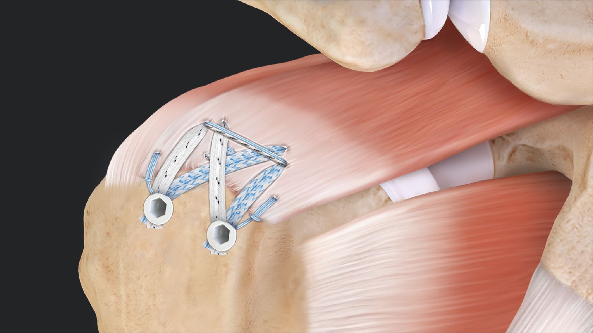 Arthrex Compression SpeedBridge Rotator Cuff Repair Arthrex Compression SpeedBridge Rotator Cuff Repair