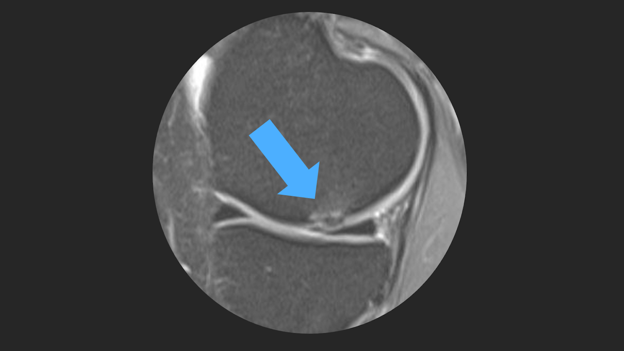 Arthrex - AutoCart™ Procedure for Treatment of Failed Microfracture