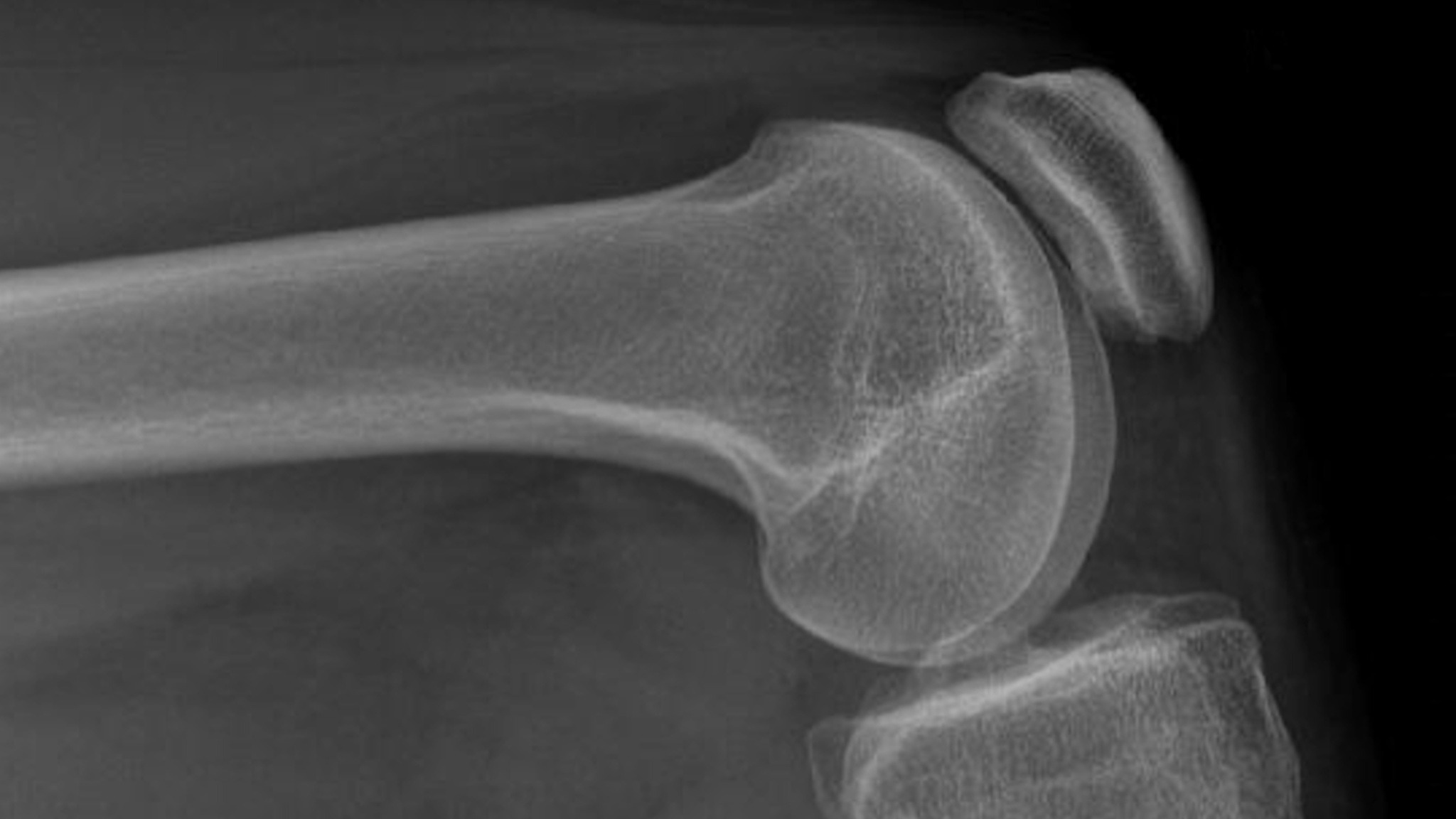 Arthrex - AutoCart™ Procedure With Trochleoplasty for a Patellar Defect