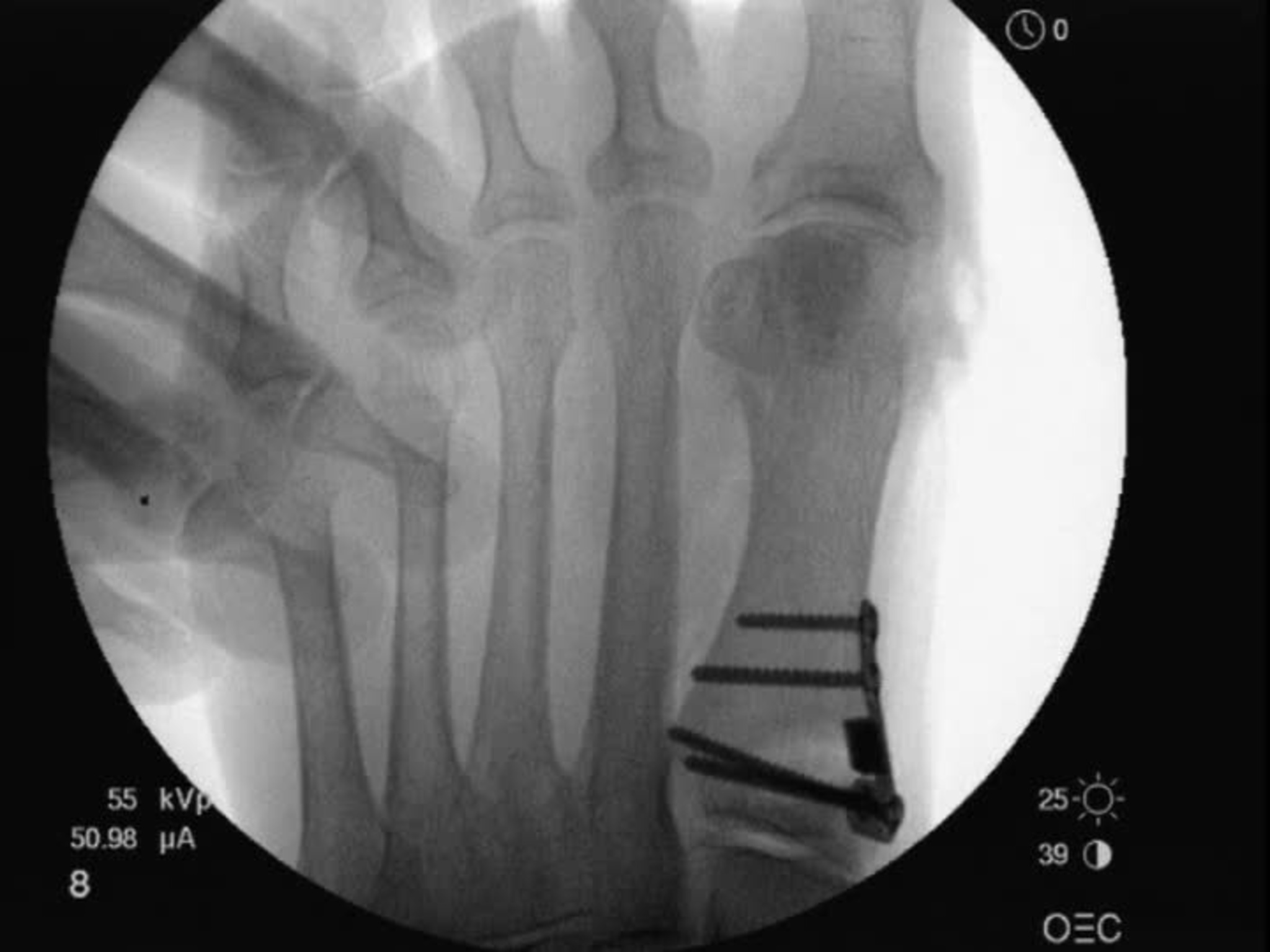 Arthrex - Proximal 1st Metatarsal Osteotomy Featuring the LPS Opening ...