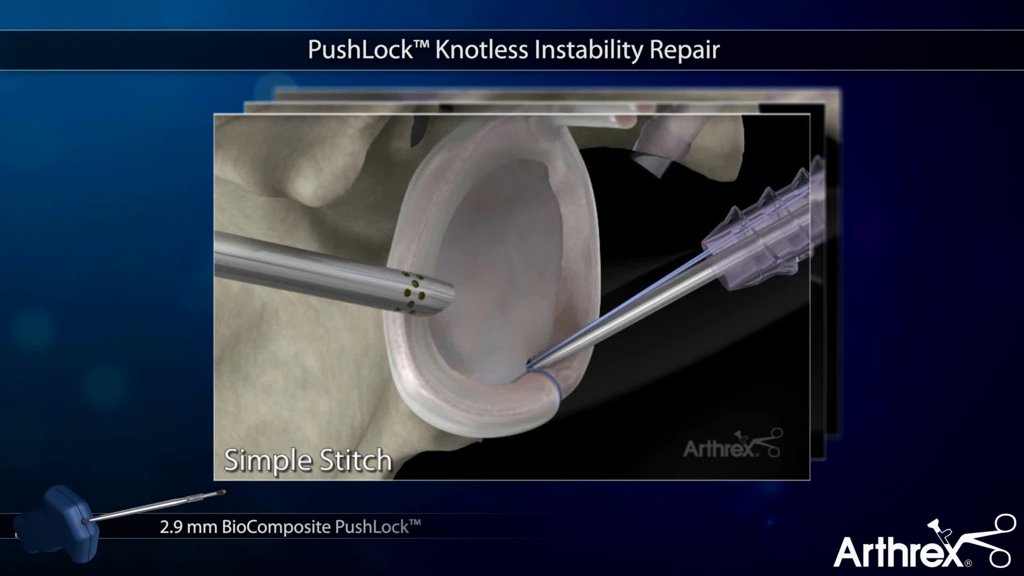 Arthrex - PushLock® Knotless Instability Repair