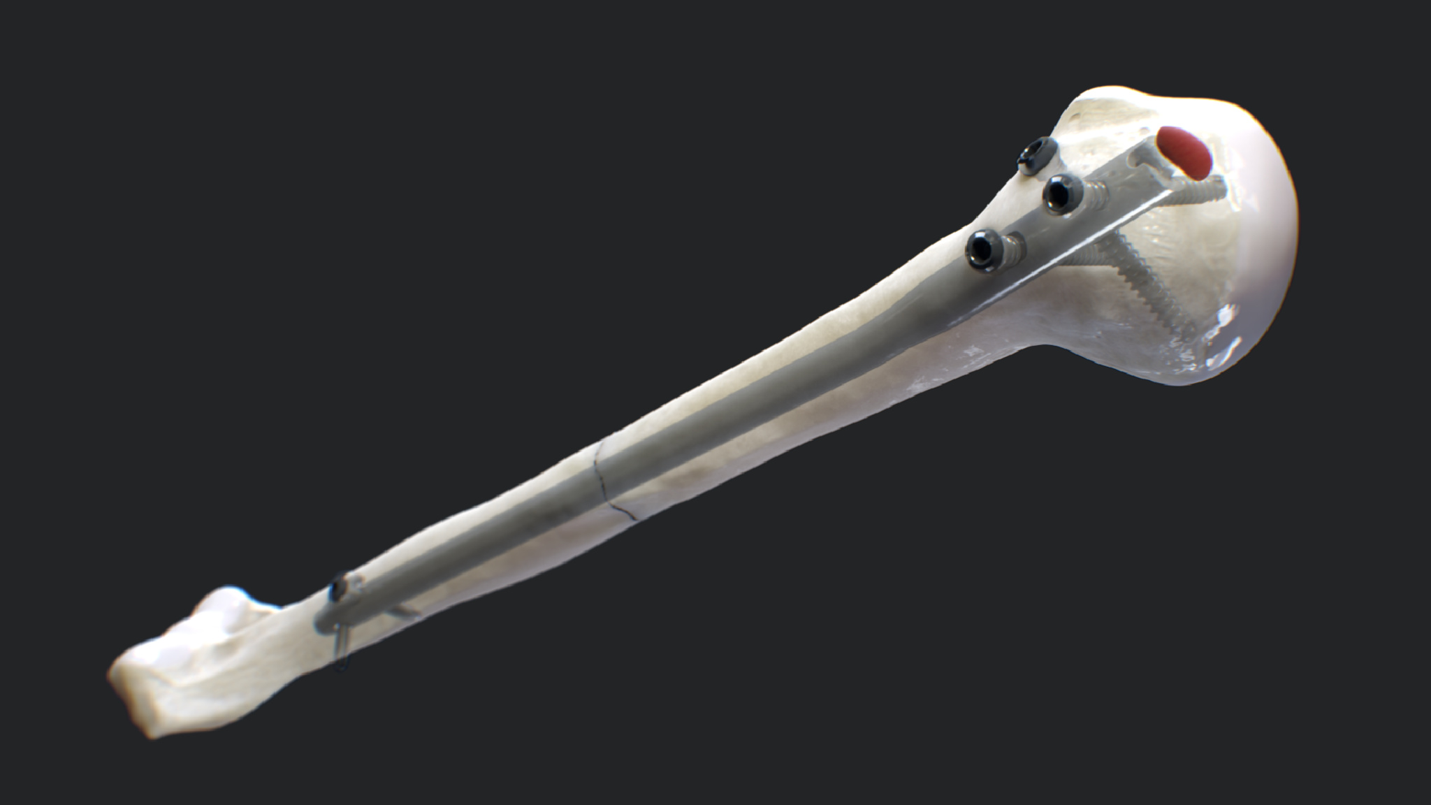 Arthrex - Long Humeral Nail System Surgical Technique