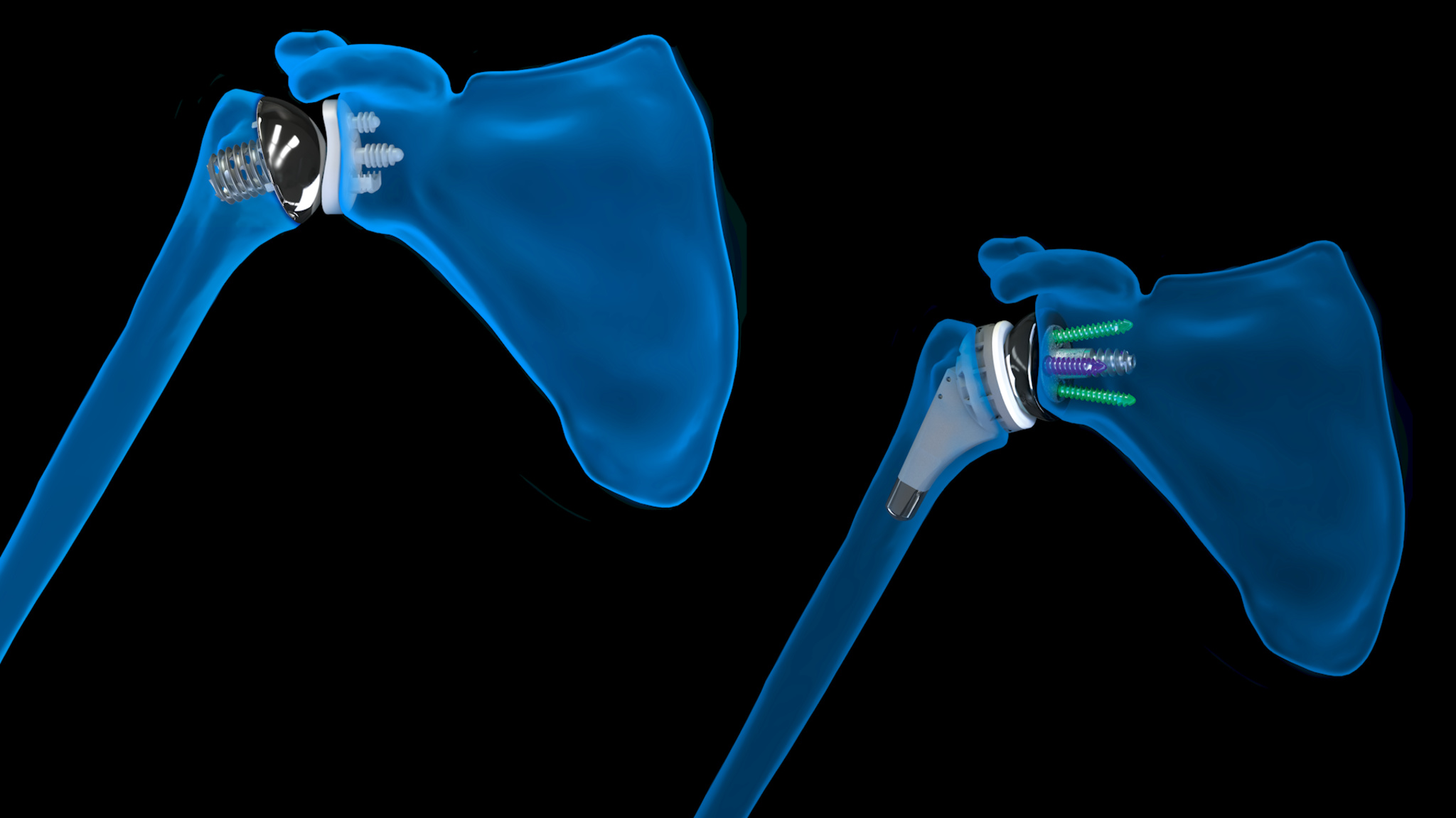 Arthrex Eclipse Total Shoulder System Ease Of Revision Arthrex Eclipse Total Shoulder System Ease Of Revision