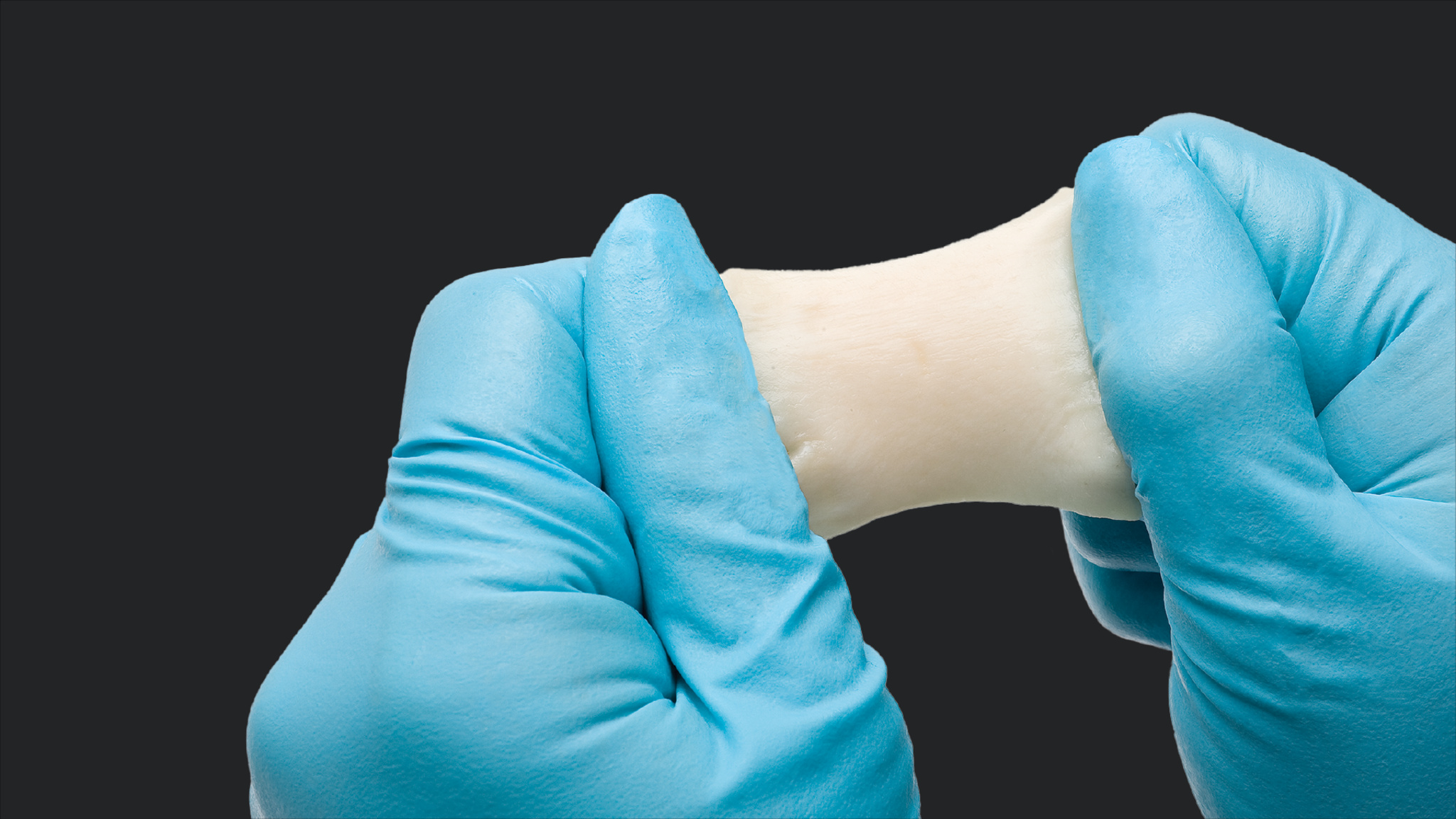 Arthrex - Challenges in the Cuff Care Continuum: Biologic Augmentation ...