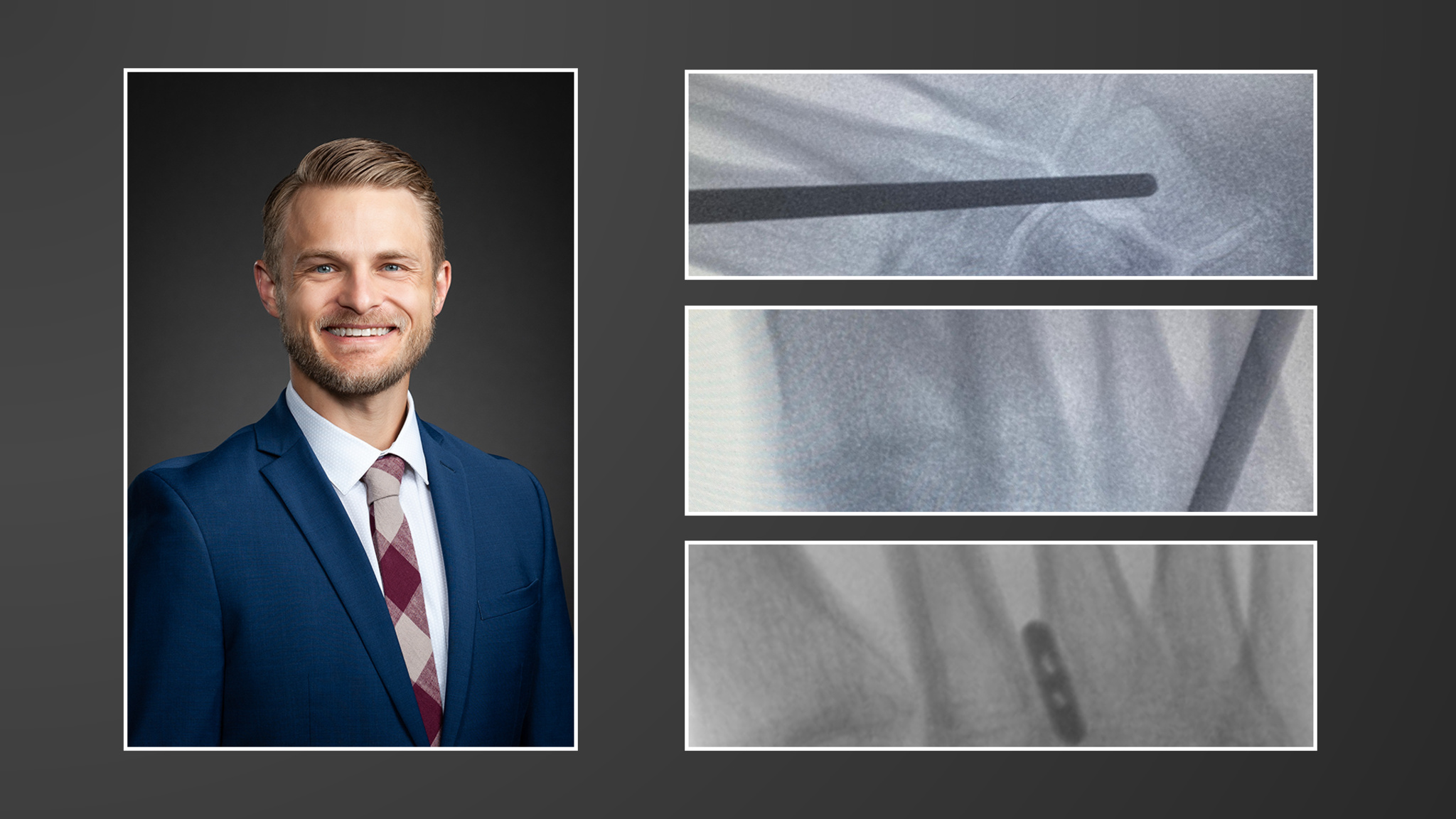 Arthrex - InternalBrace™ Technique for a Lisfranc Injury With IOBP ...