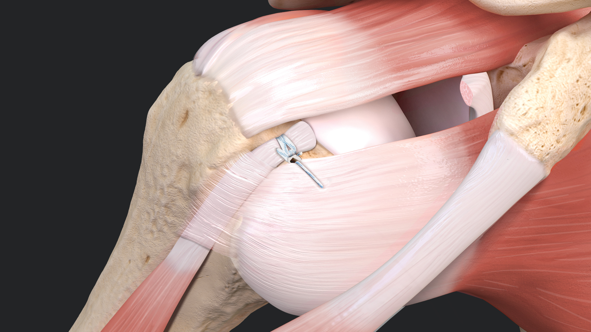 Arthrex - Biceps Tenodesis Using the Loop 'N' Tack™ System