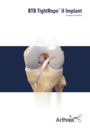 Arthrex - ACL TightRope® II Implant