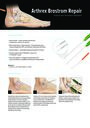 Arthrex - Arthrex® Brostrom Repair