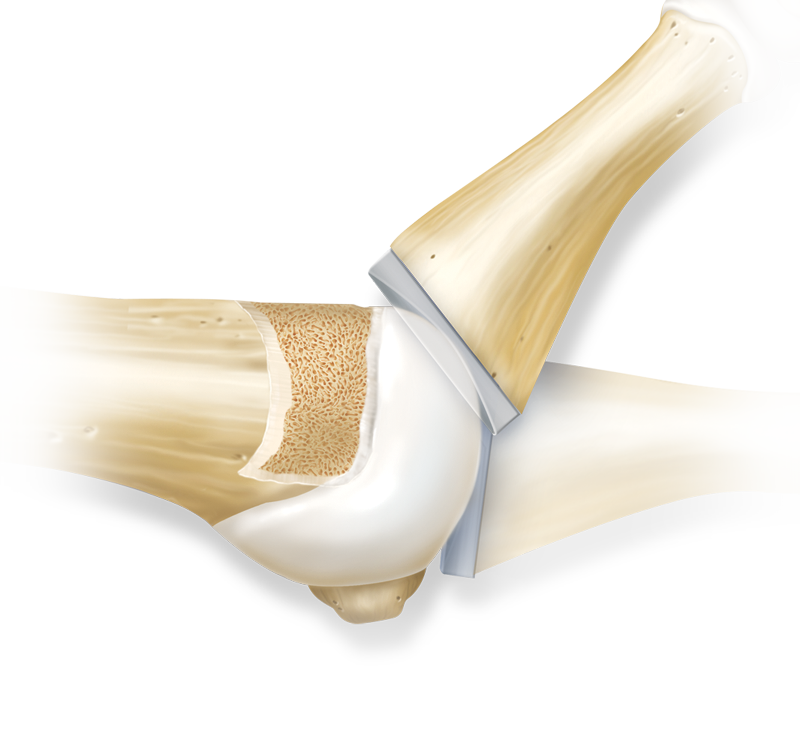 Arthrex - AnaToemic® Hemi-Prosthesis