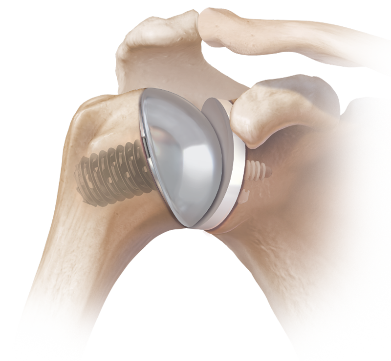 Arthrex - Artroplastia - Ombro
