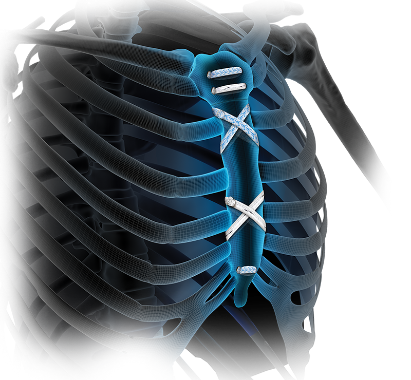 Arthrex - Cirugía cardiotorácica