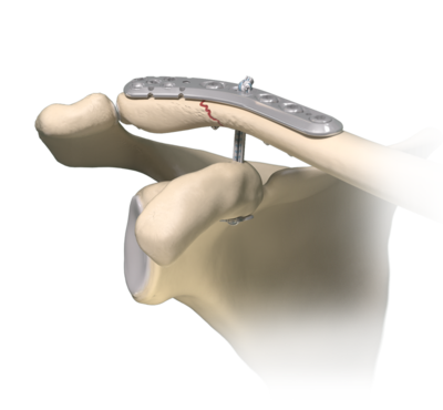 Arthrex - Clavicle Fracture Implants