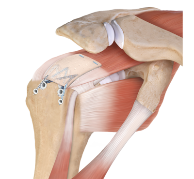 Arthrex - CuffMend™ Augmentation System