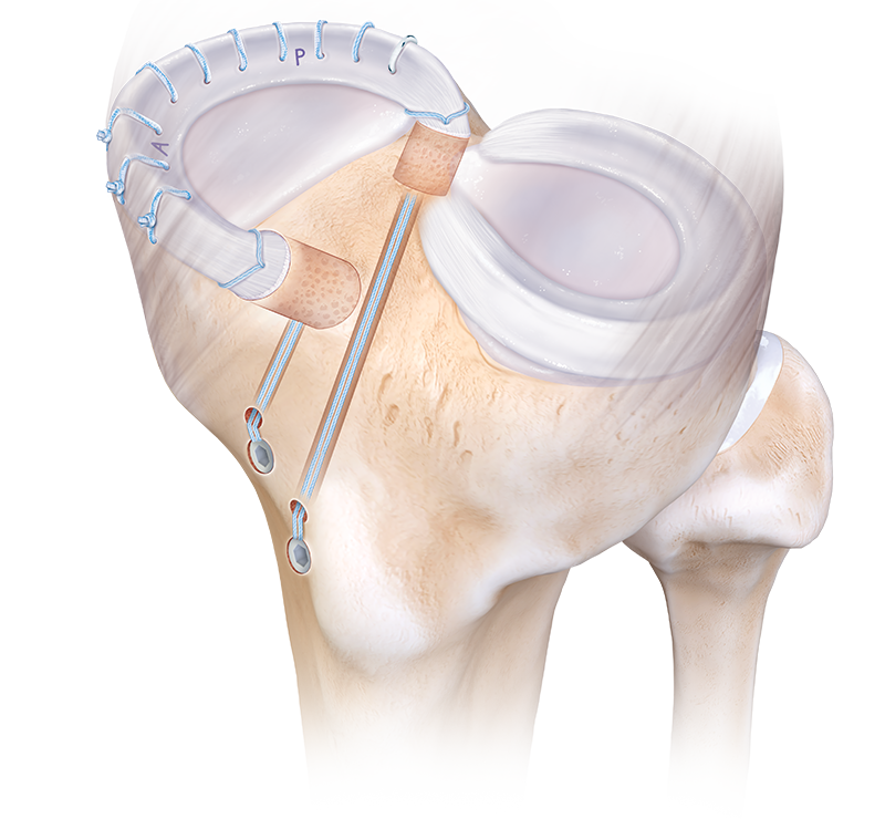 Arthrex - Double Bone Plug Meniscal Transplant