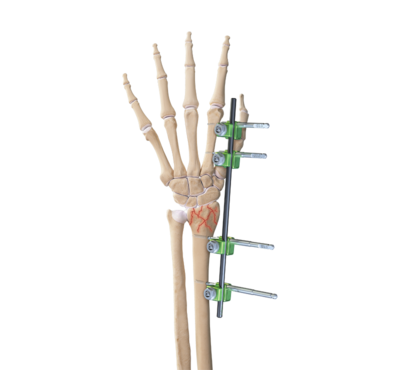 Arthrex - Small External Fixator