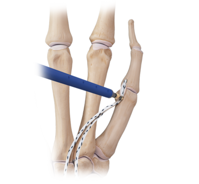 Arthrex - Implant System, Hand/Wrist InternalBrace Ligament ...