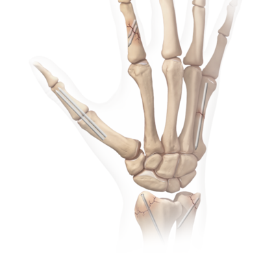 Arthrex - Fracture and Fusion Devices