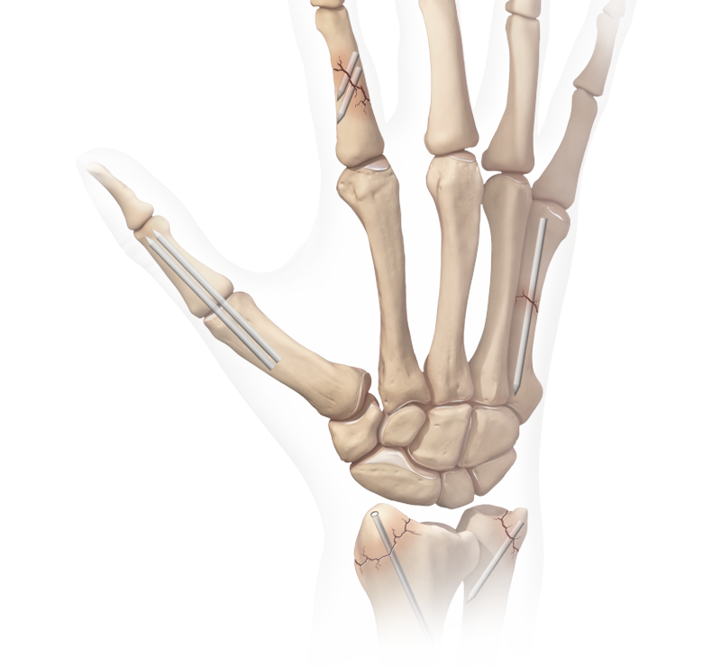 Arthrex - Fracture and Fusion Devices