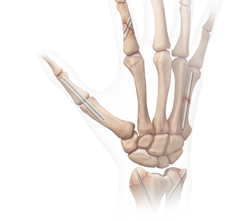 Arthrex - Osteoarthritis