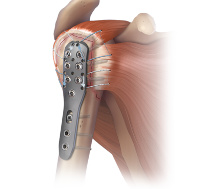 Arthrex - Humeral Fracture Implants