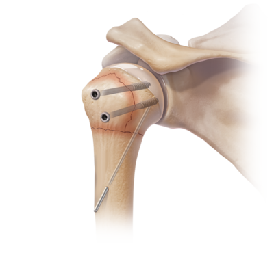 Arthrex - Humeral Fracture Implants