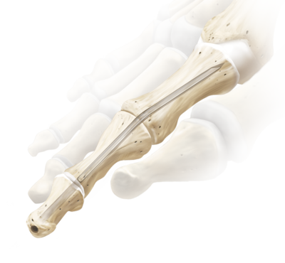 Arthrex - Interphalangeal Joint Fusion