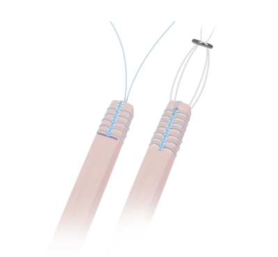 Arthrex - FiberLoop® with FiberTag™ Suture