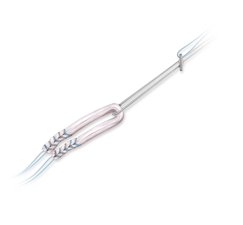 Arthrex - Knee Ligament Fixation Devices