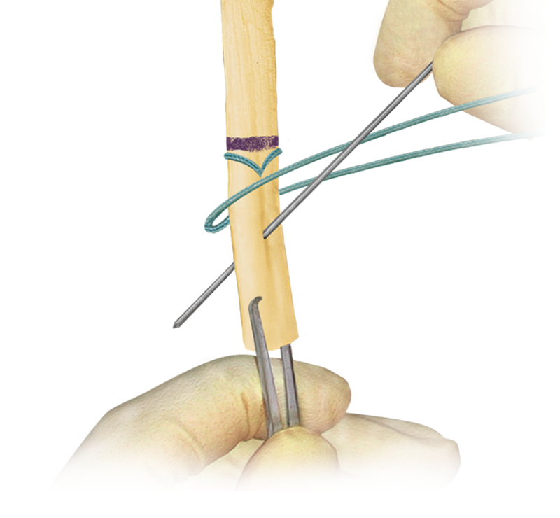 Arthrex - Graft Harvest and Preparation