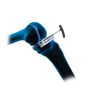 Arthrex - iBalance® UKA System