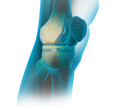 Arthrex - Arthroplasty Knee
