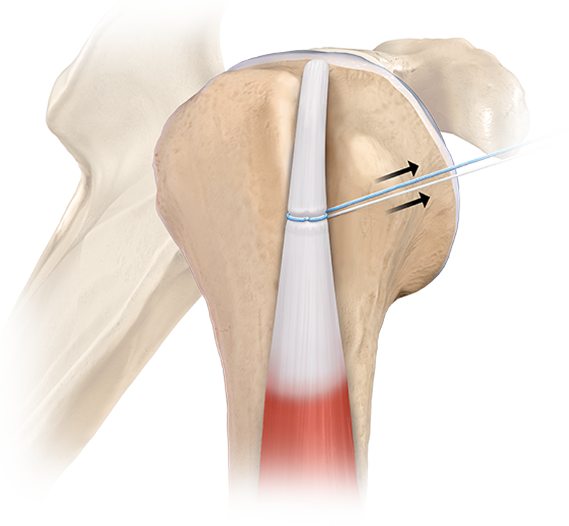 Arthrex - Knotless FiberTak® Biceps Tenodesis